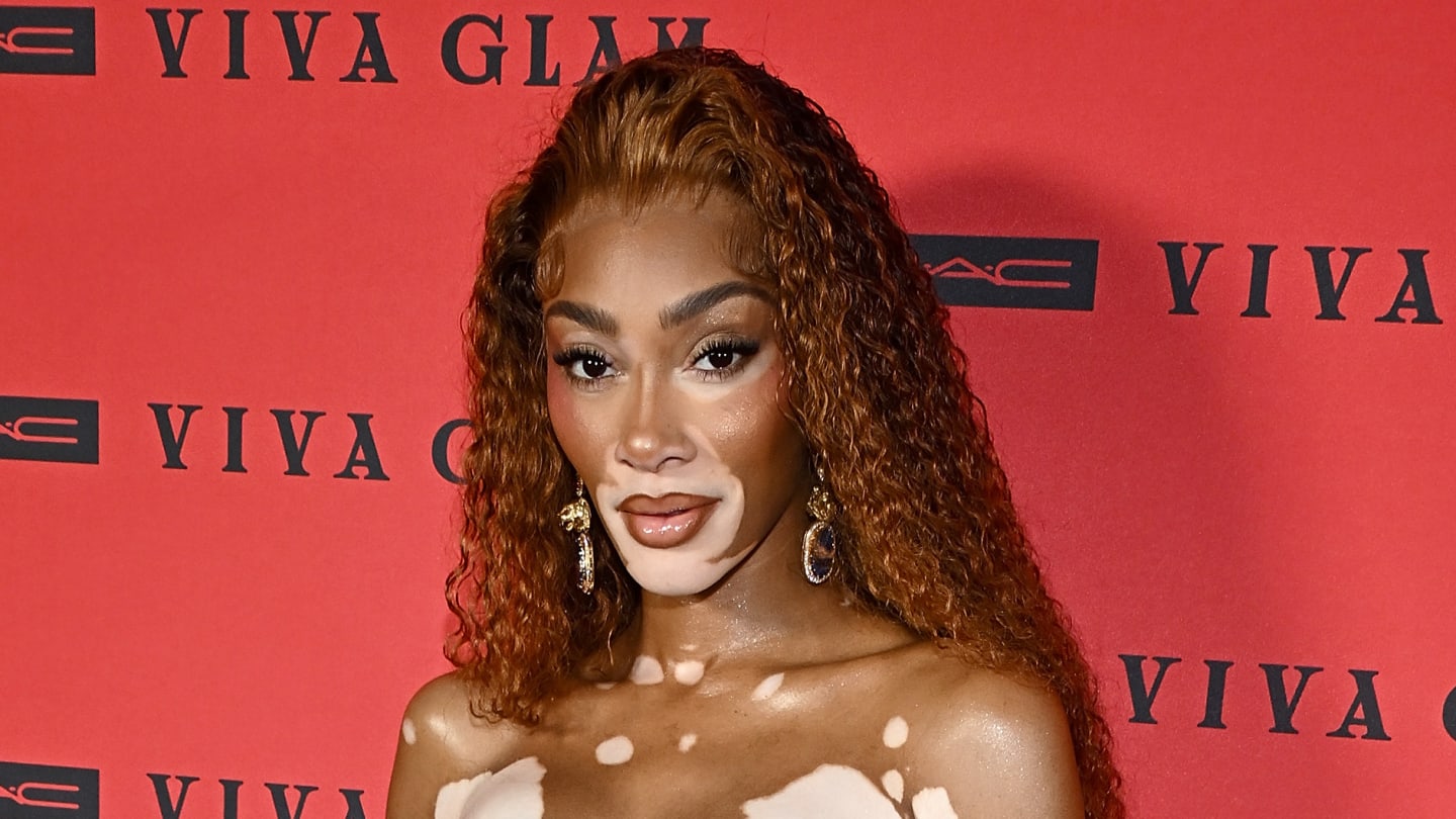 Winnie Harlow Shares Powerful Message for World Vitiligo Day