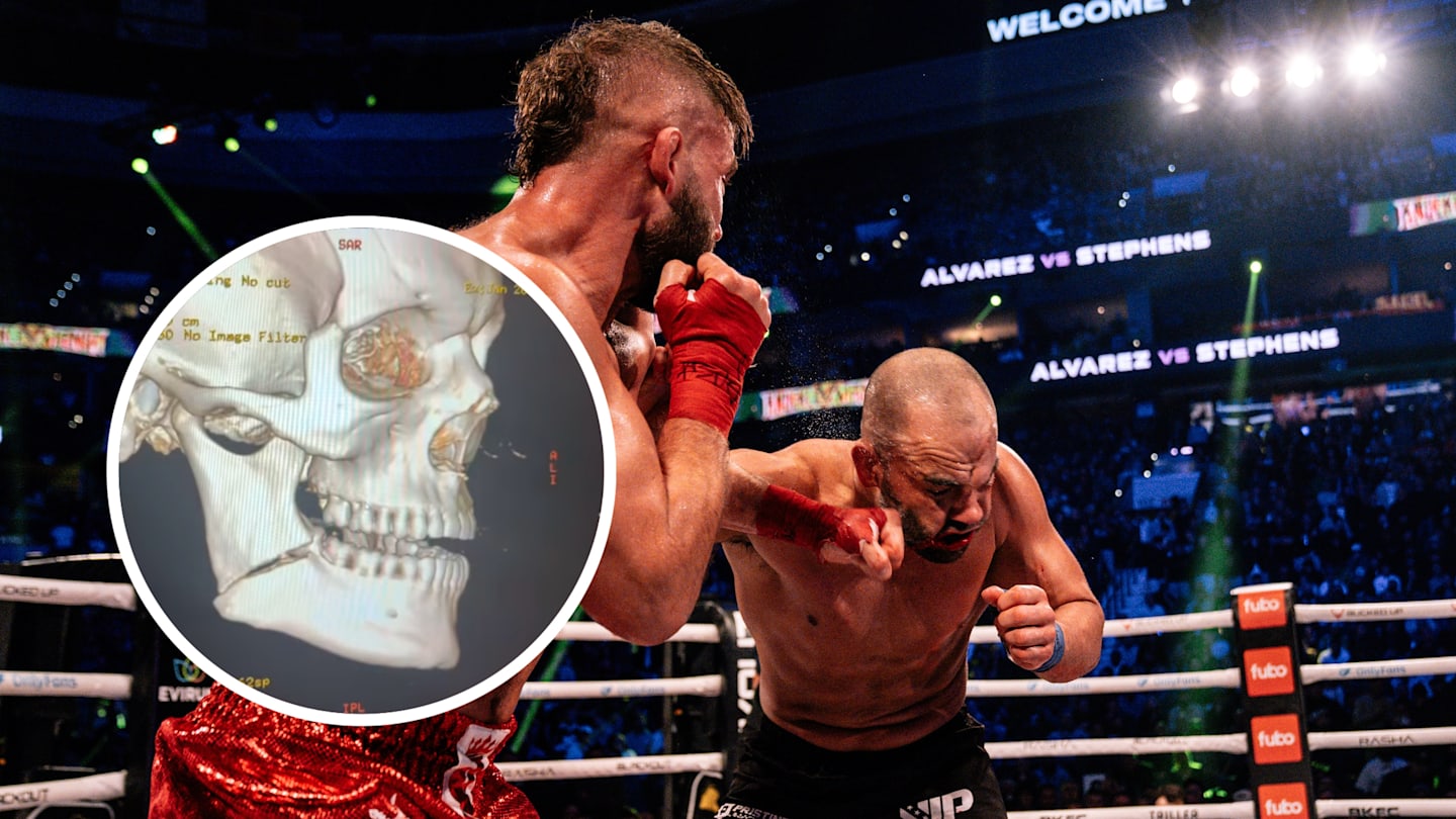 Eddie Alvarez shares X-Ray of Broken Jaw from Jeremy Stephens fight at ...