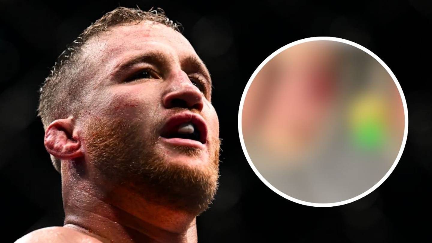 Justin Gaethje shows off gnarly injury a week after fighting at UFC 313