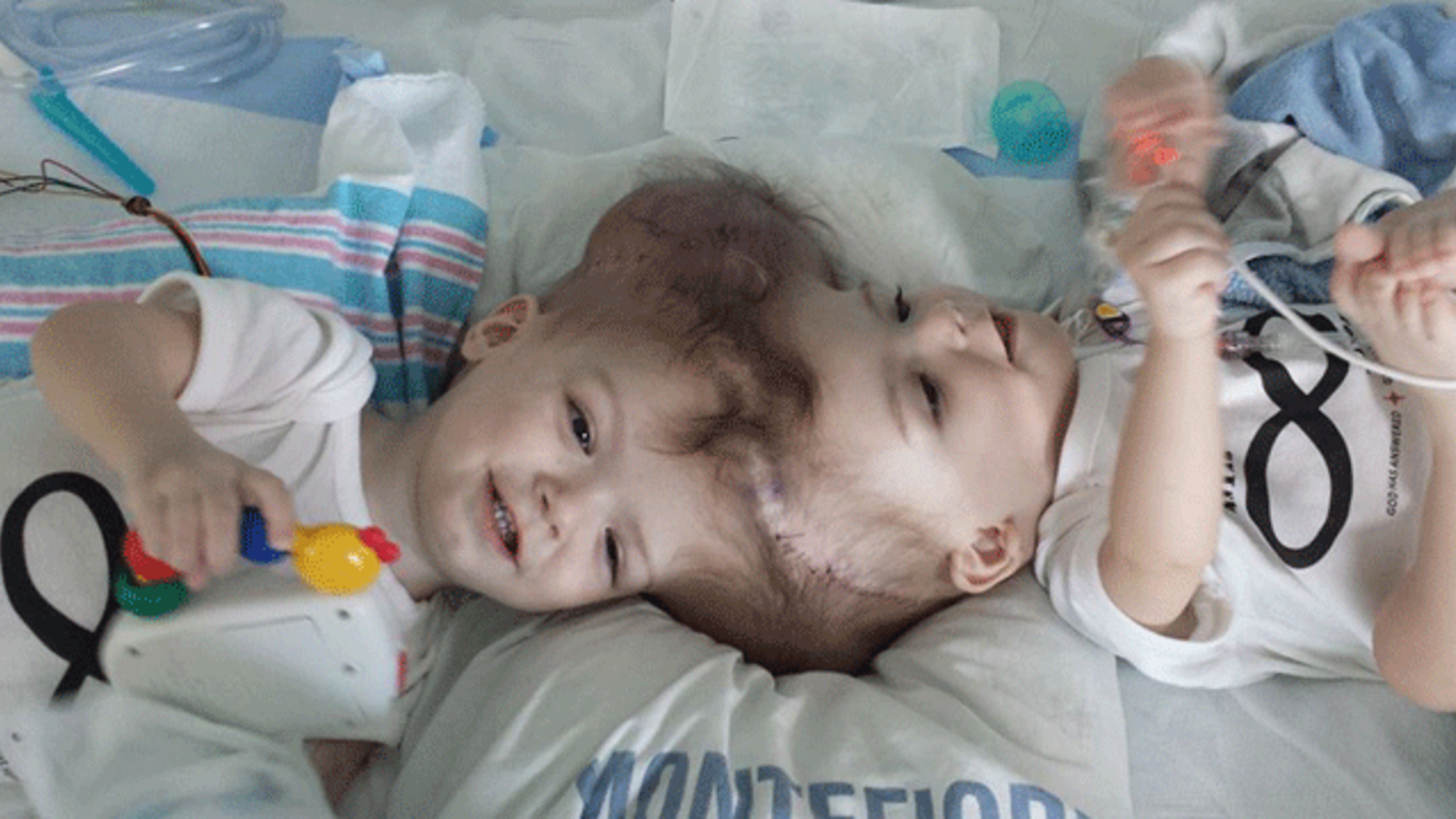Twins Conjoined at the Head Separated After 27 Hours of Surgery ...