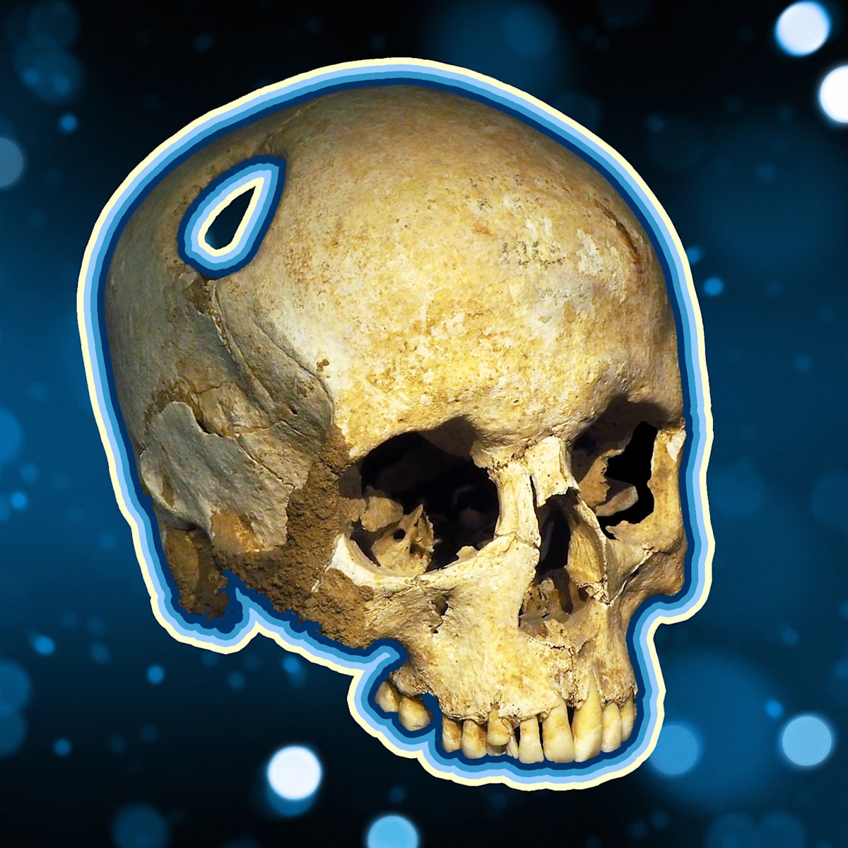 does trepanation work