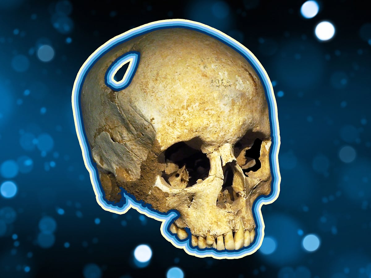 trepanation skull