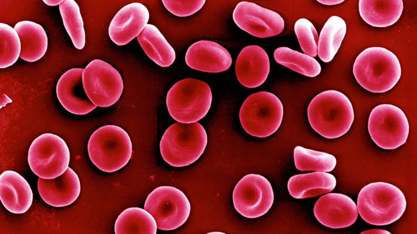 11 Facts About Anemia