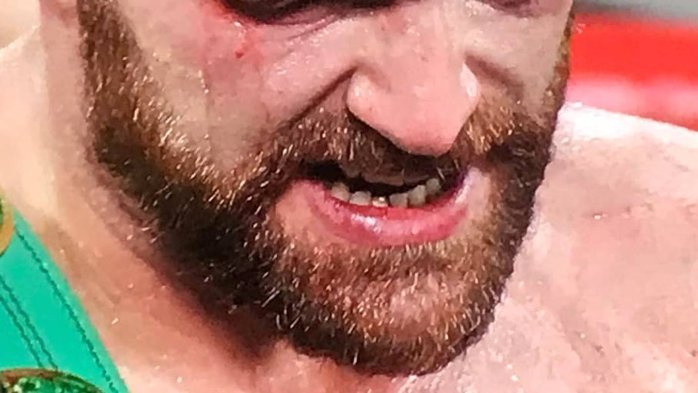 Overhead Photo of Tyson Fury's Cut Above His Eye is Disgusting
